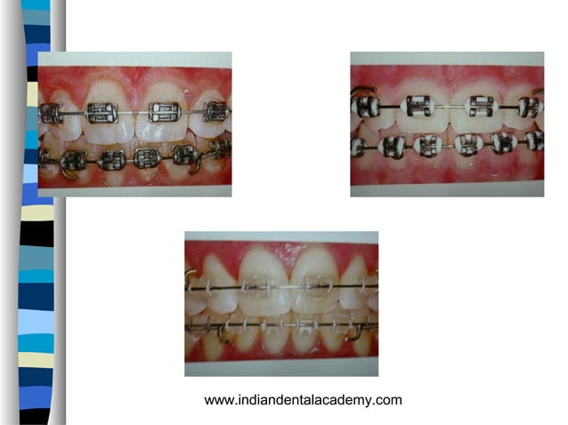 MBT system in orthodontics /certified fixed orthodontic courses by ...