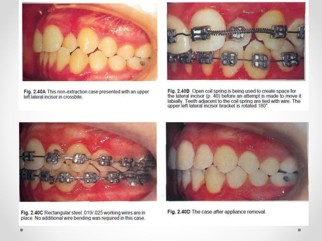 Mbt technique part | PPTX | Dental Health | Diseases and Conditions