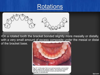 Mbt technique part | PPTX