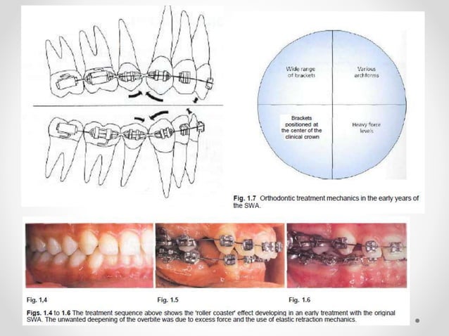 Mbt technique part | PPTX | Dental Health | Diseases and Conditions