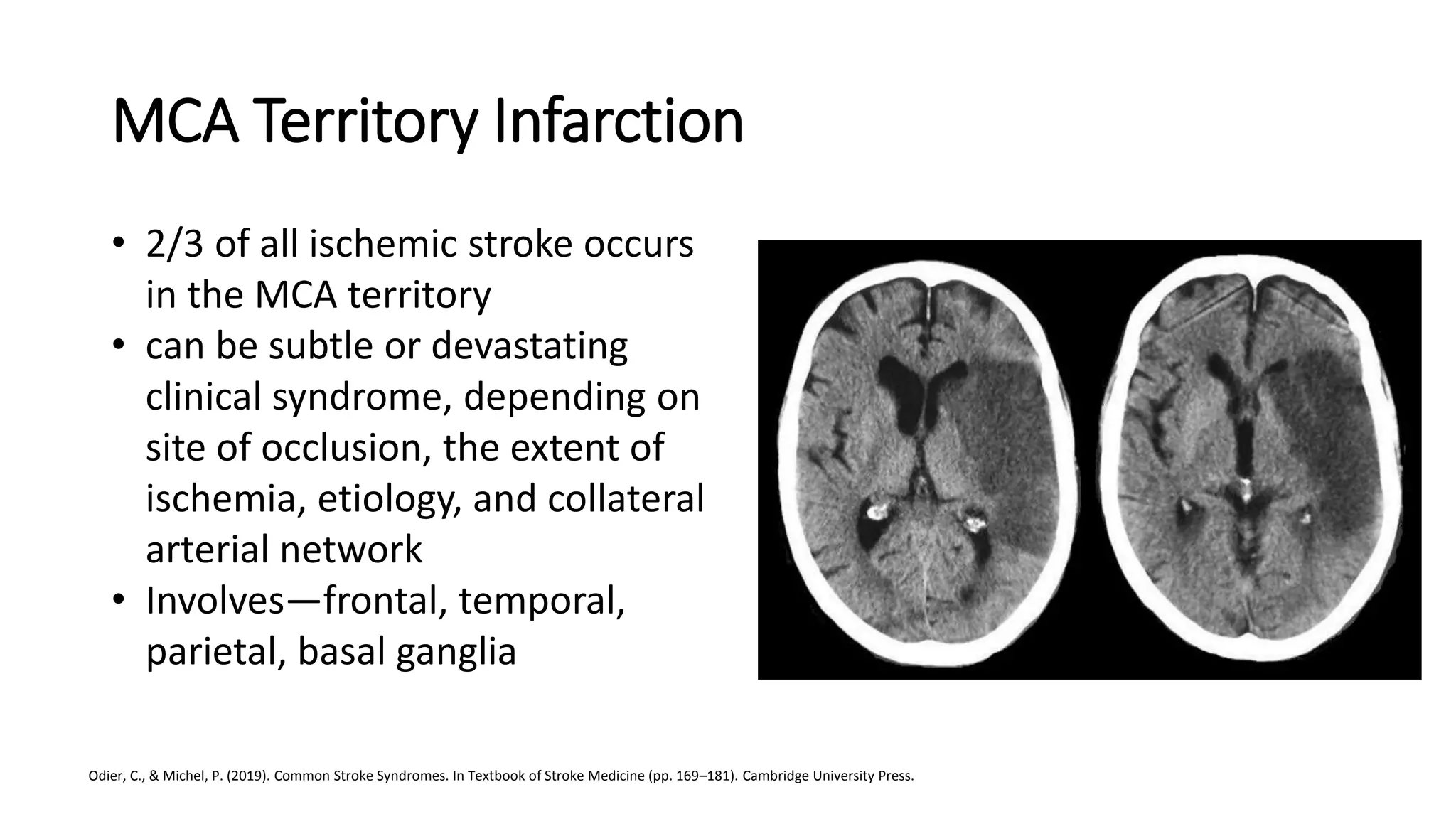 Mca & aca syndromes | PPTX