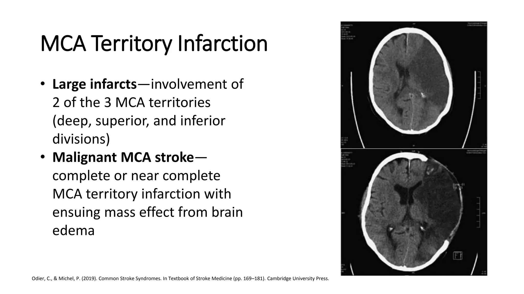 Mca & aca syndromes | PPTX