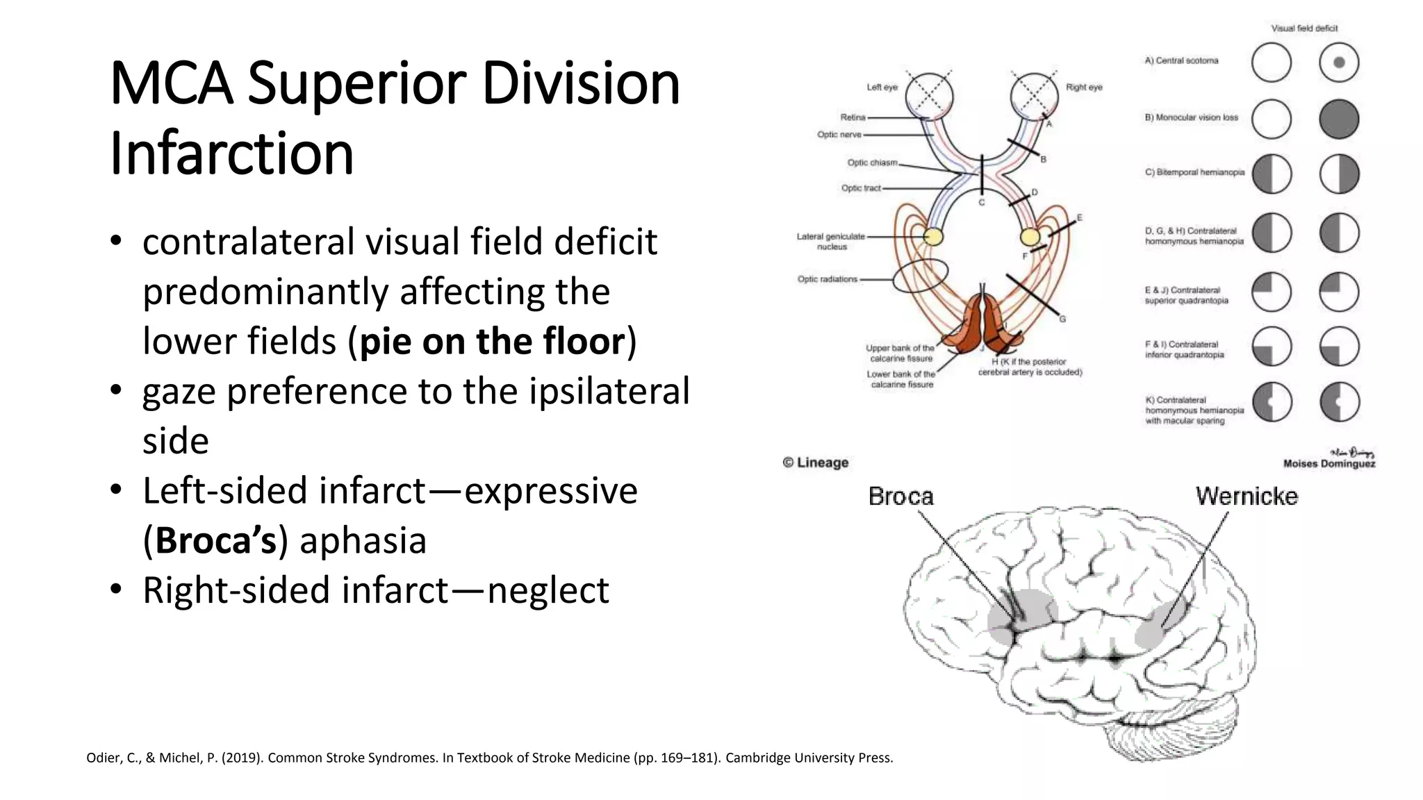 Mca & aca syndromes | PPTX