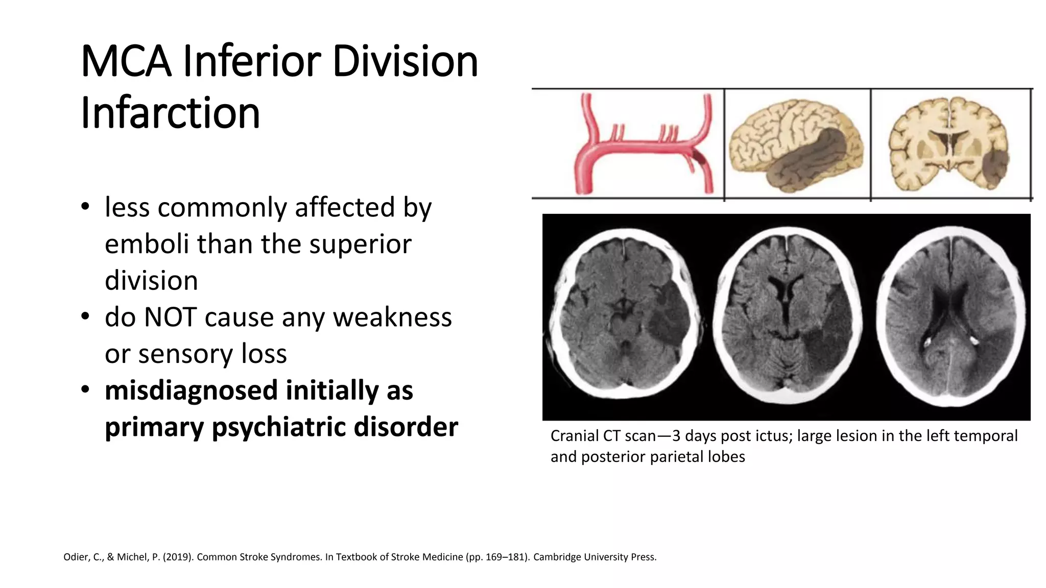 Mca & aca syndromes | PPTX