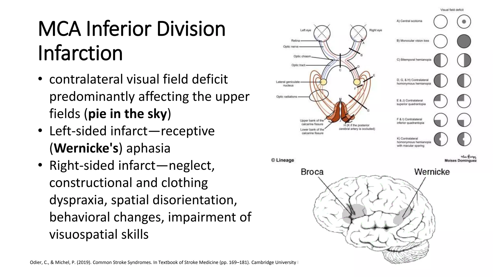 Mca & aca syndromes | PPTX
