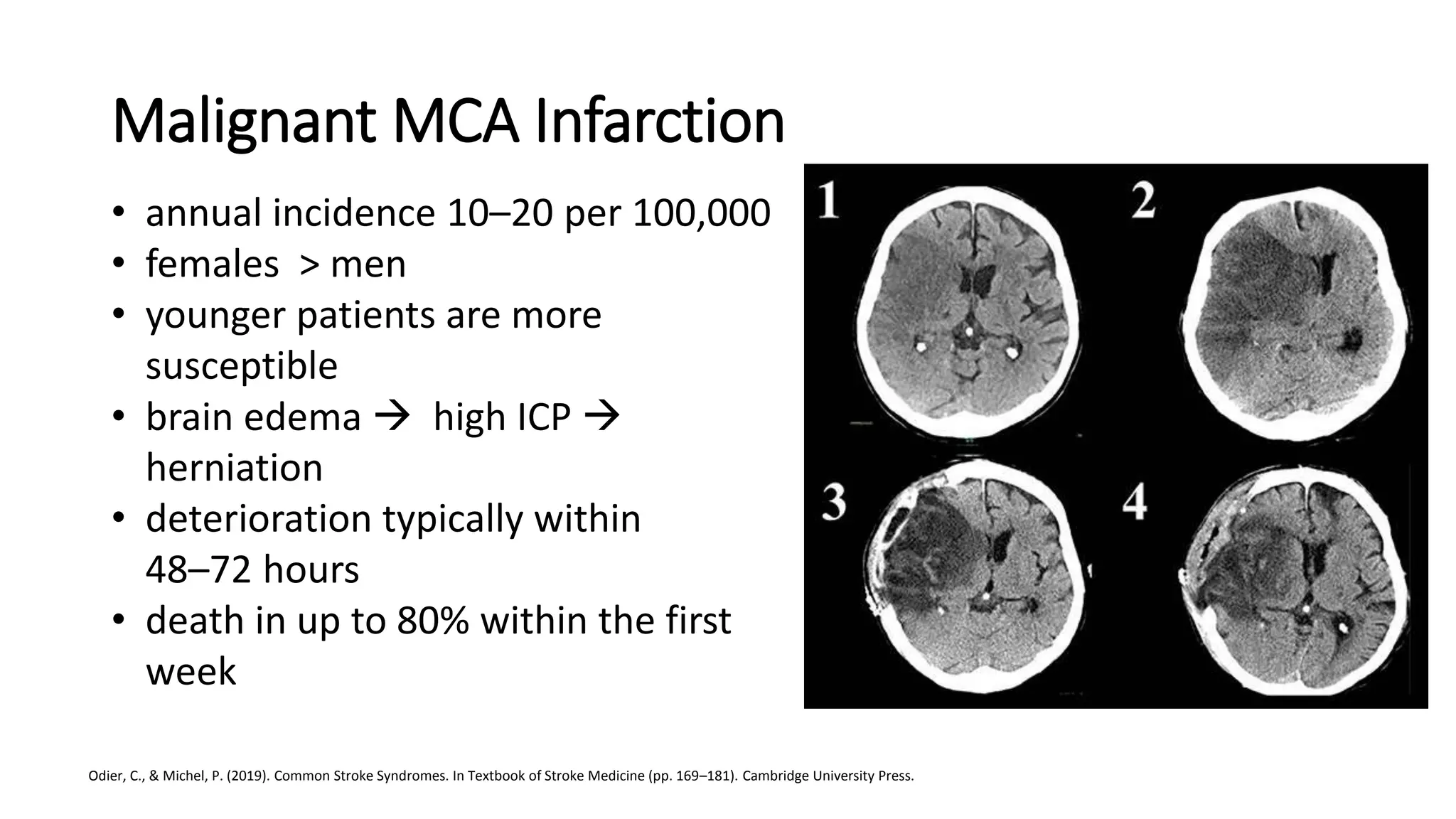 Mca & aca syndromes | PPTX