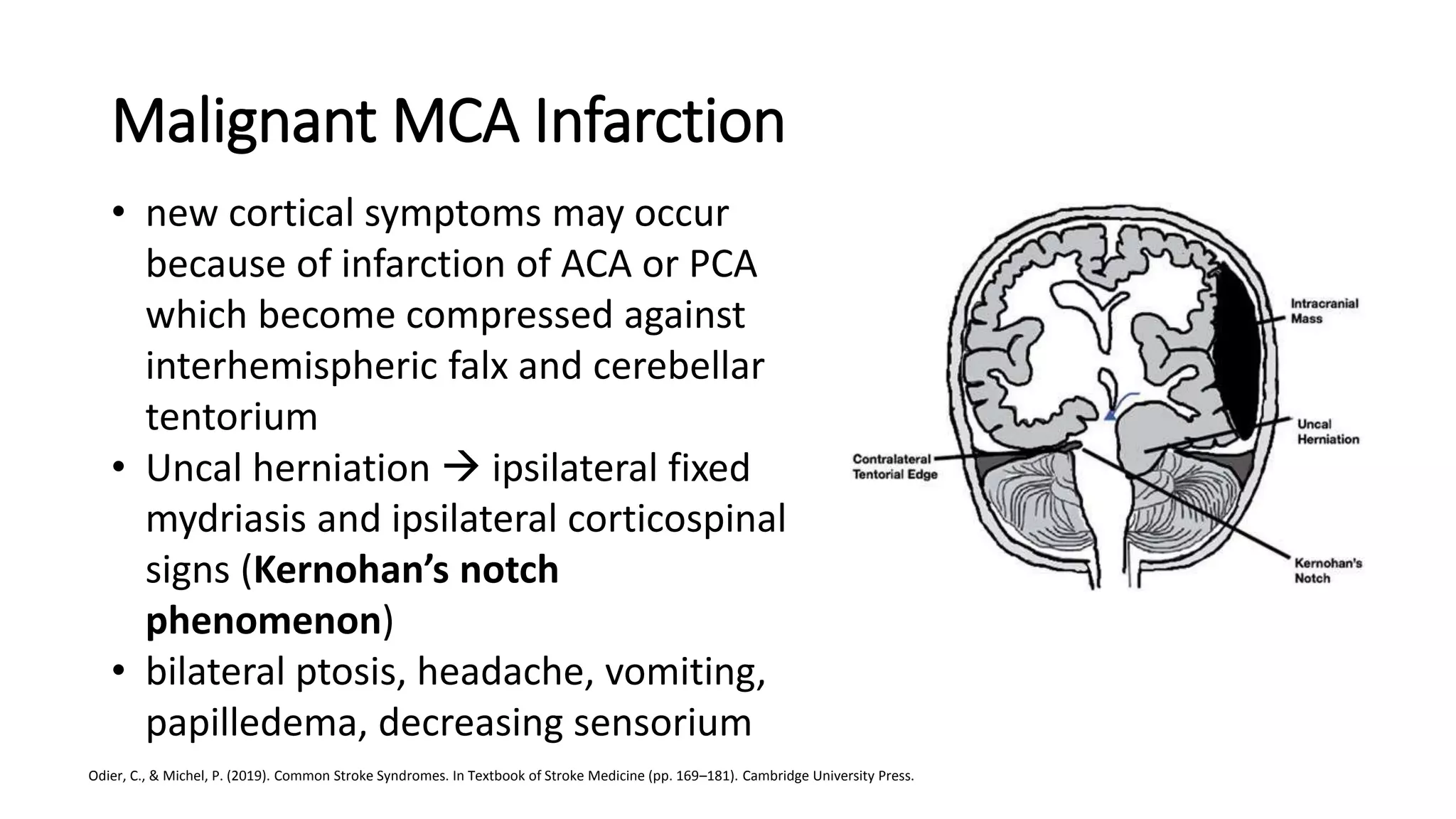 Mca & aca syndromes | PPTX