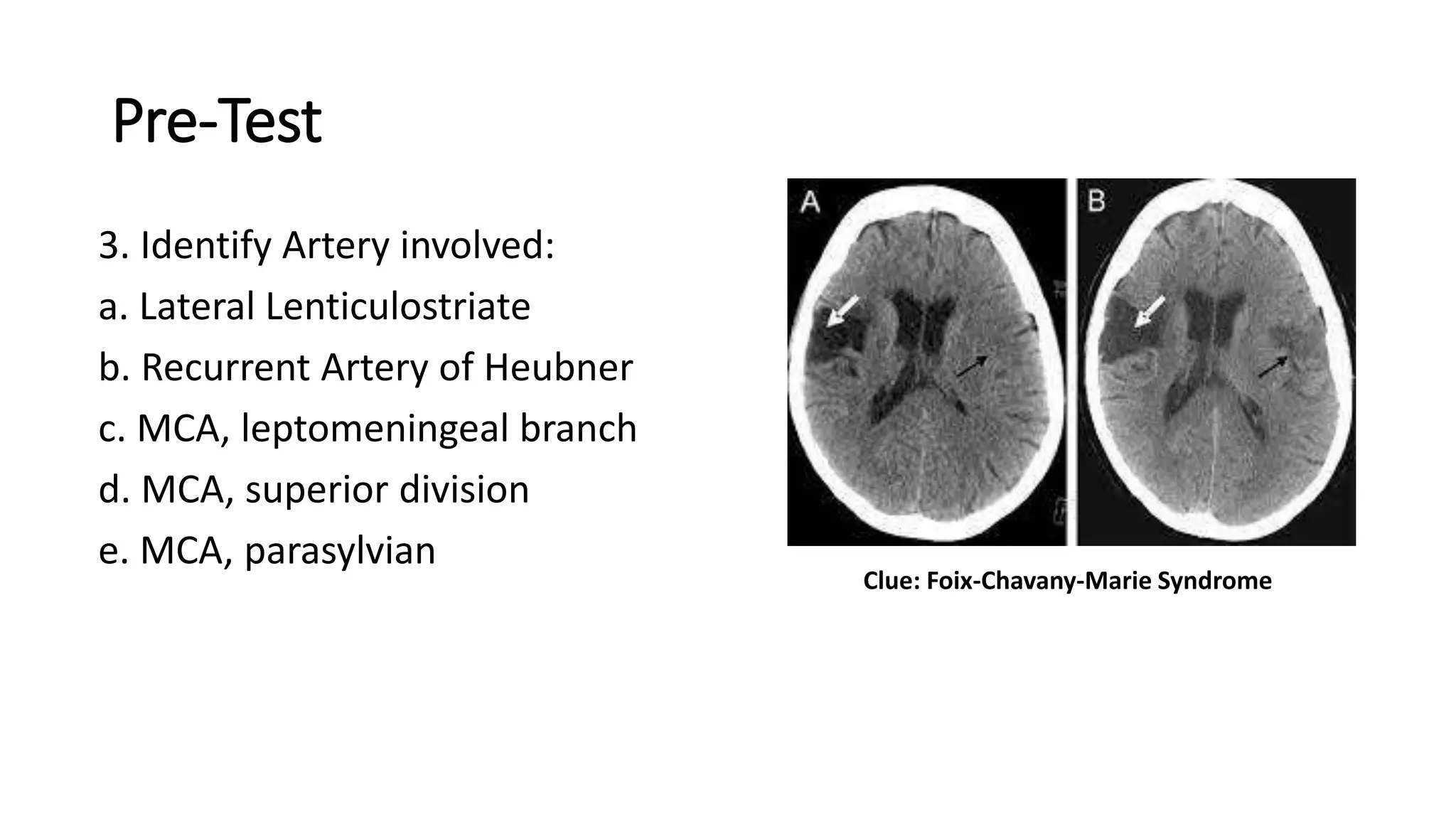 Mca & aca syndromes | PPTX