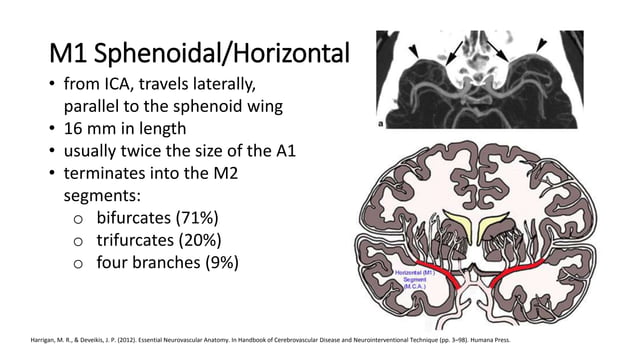 Mca & aca syndromes | PPTX