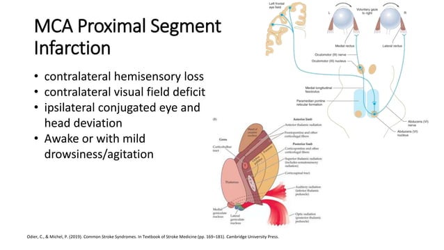 Mca & aca syndromes | PPTX