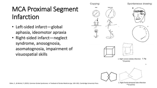 Mca & aca syndromes | PPTX