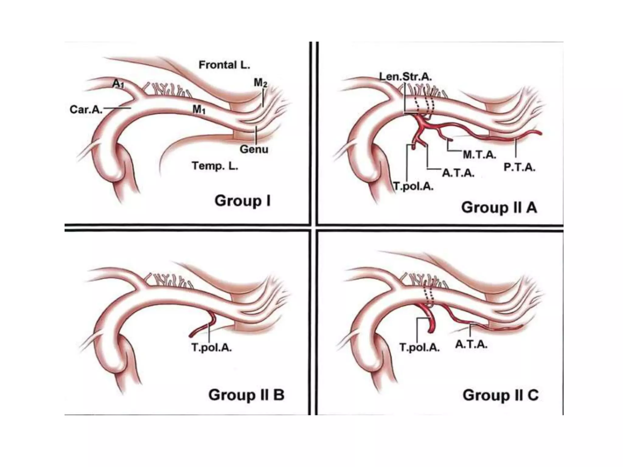 Middle Cerebral Artery Anatomy Ppt