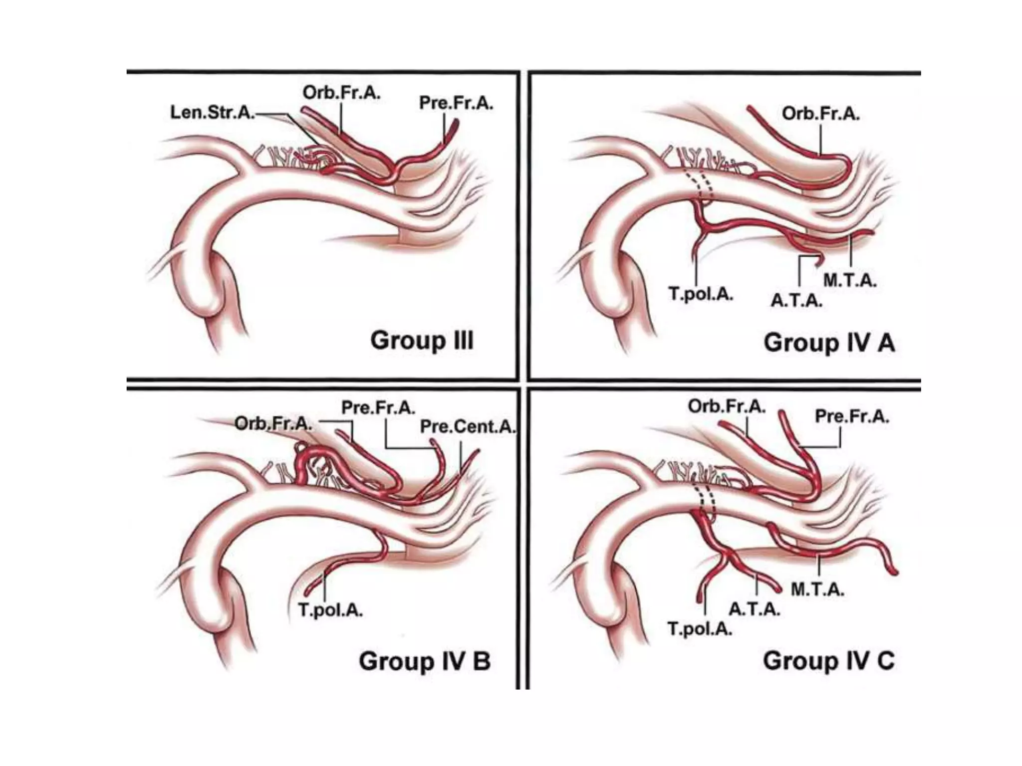 Middle Cerebral Artery Anatomy Ppt