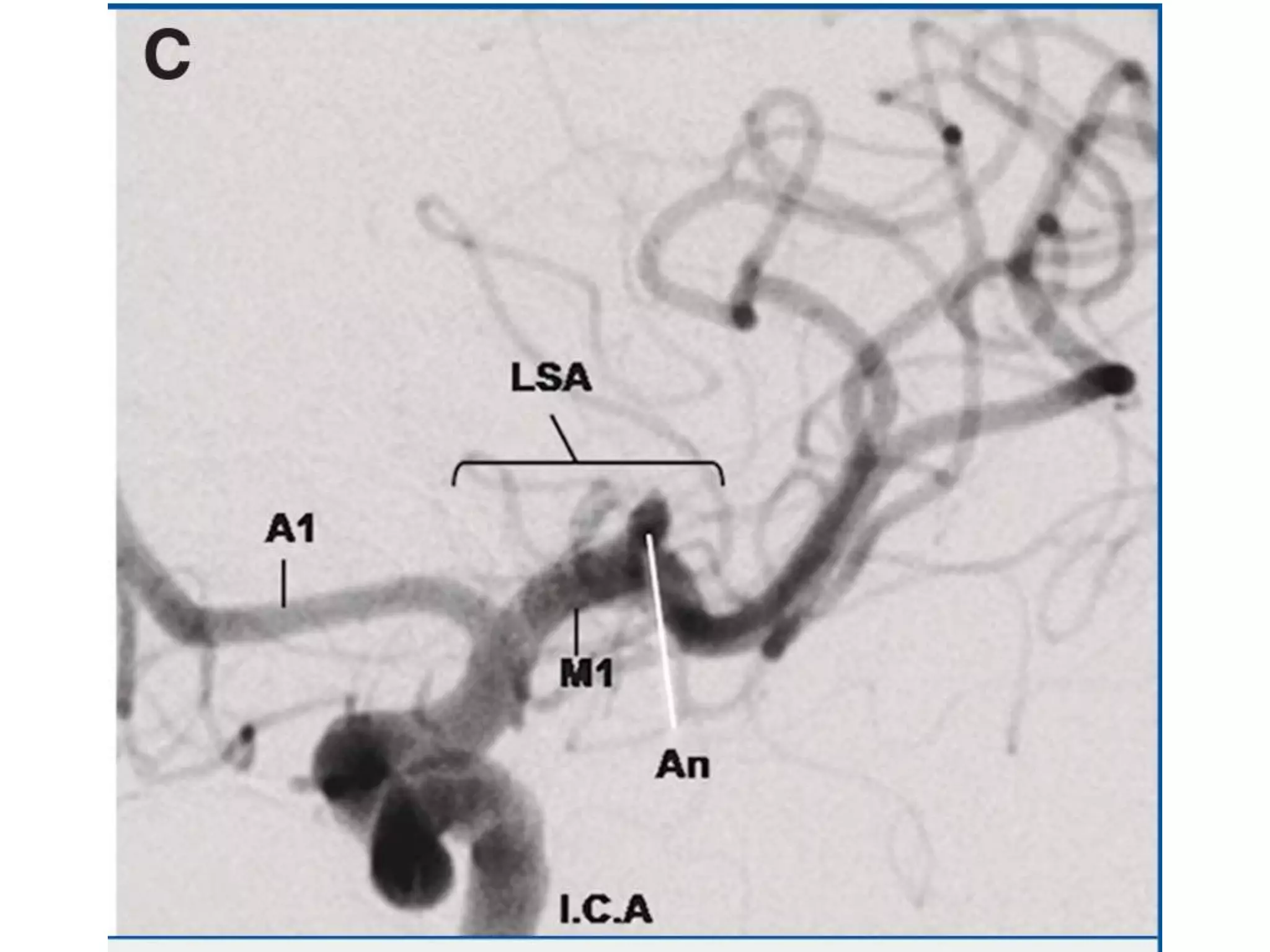 middle cerebral artery anatomy | PPTX