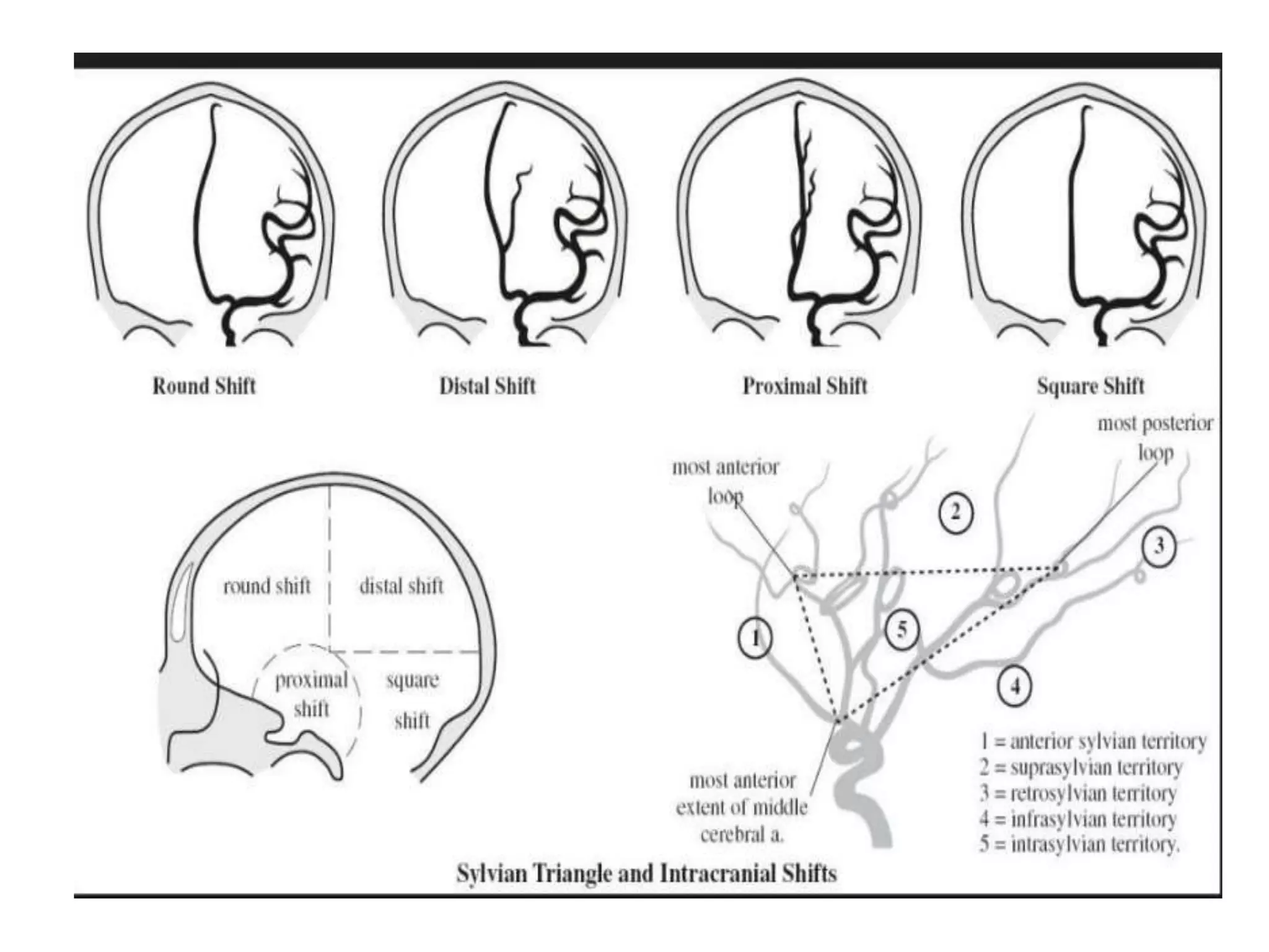 Middle Cerebral Artery Anatomy Ppt