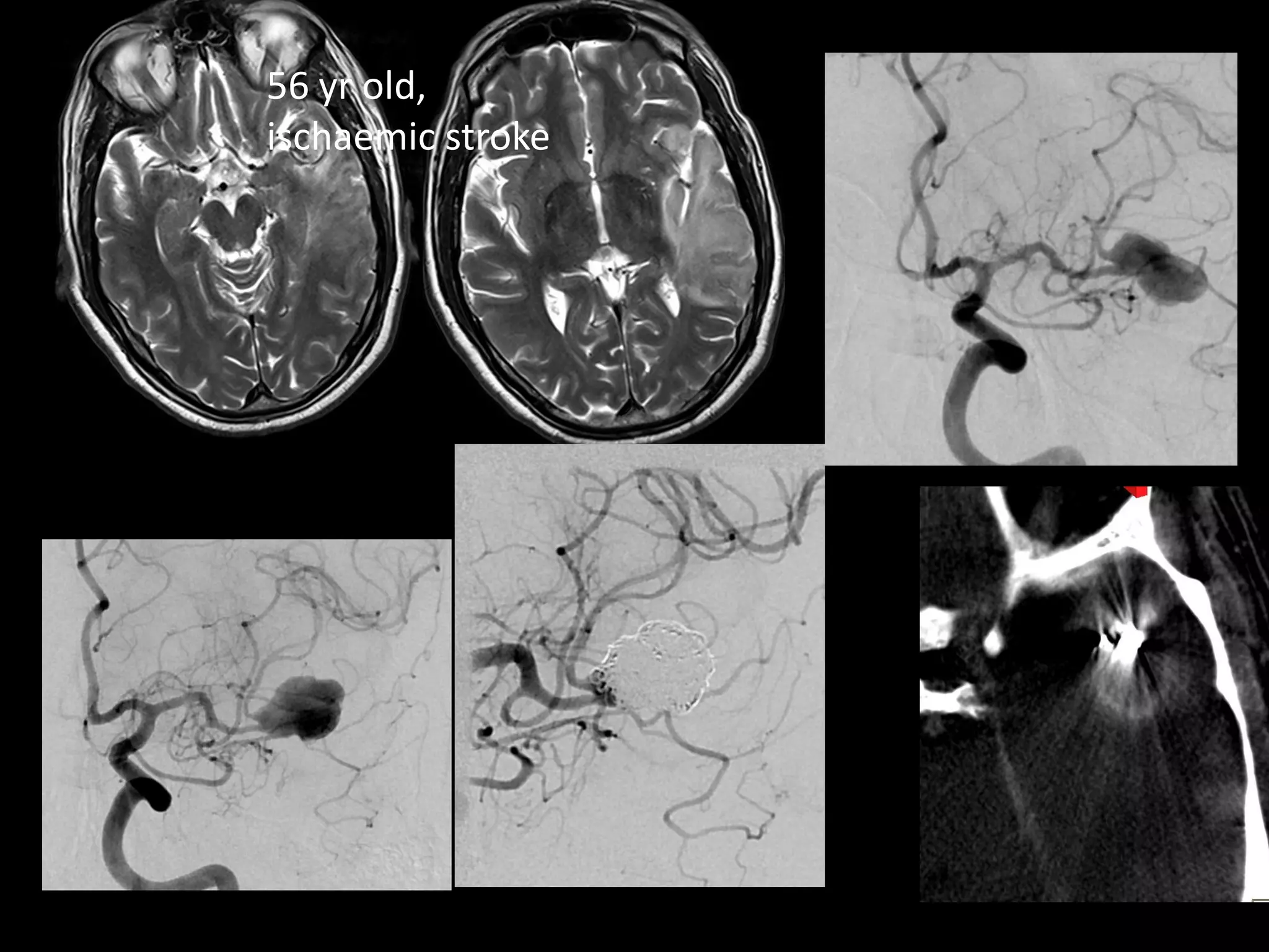 Clipping or Coiling for MCA Aneurysm | PDF