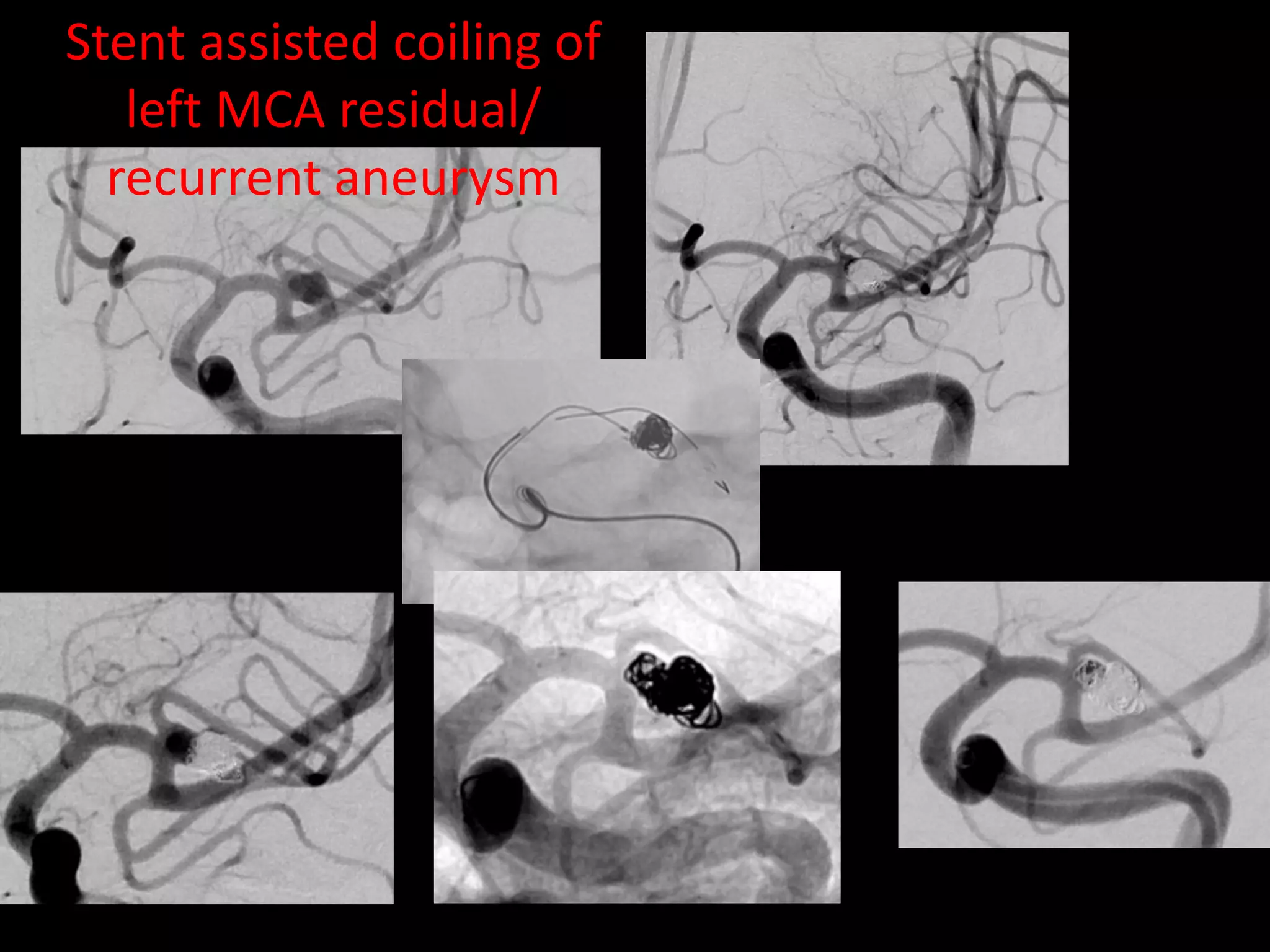 Clipping or Coiling for MCA Aneurysm | PDF