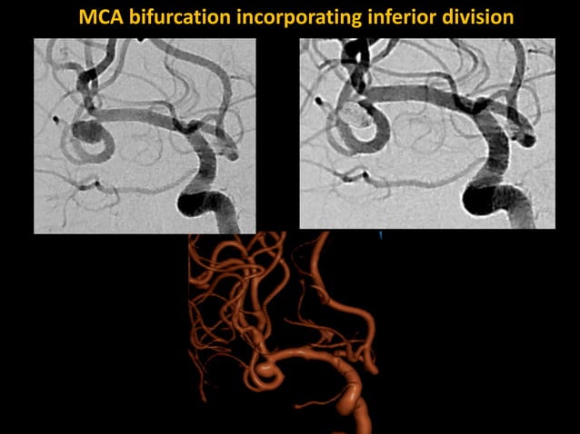 Clipping or Coiling for MCA Aneurysm | PDF