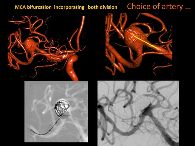 Clipping or Coiling for MCA Aneurysm | PDF