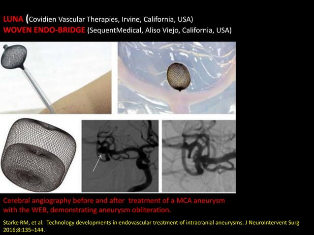 Clipping or Coiling for MCA Aneurysm | PDF