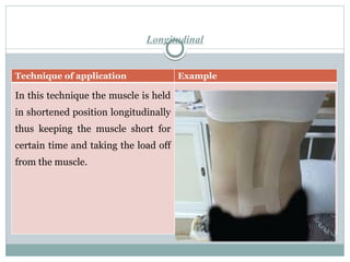 Mcconnell taping technique | PDF