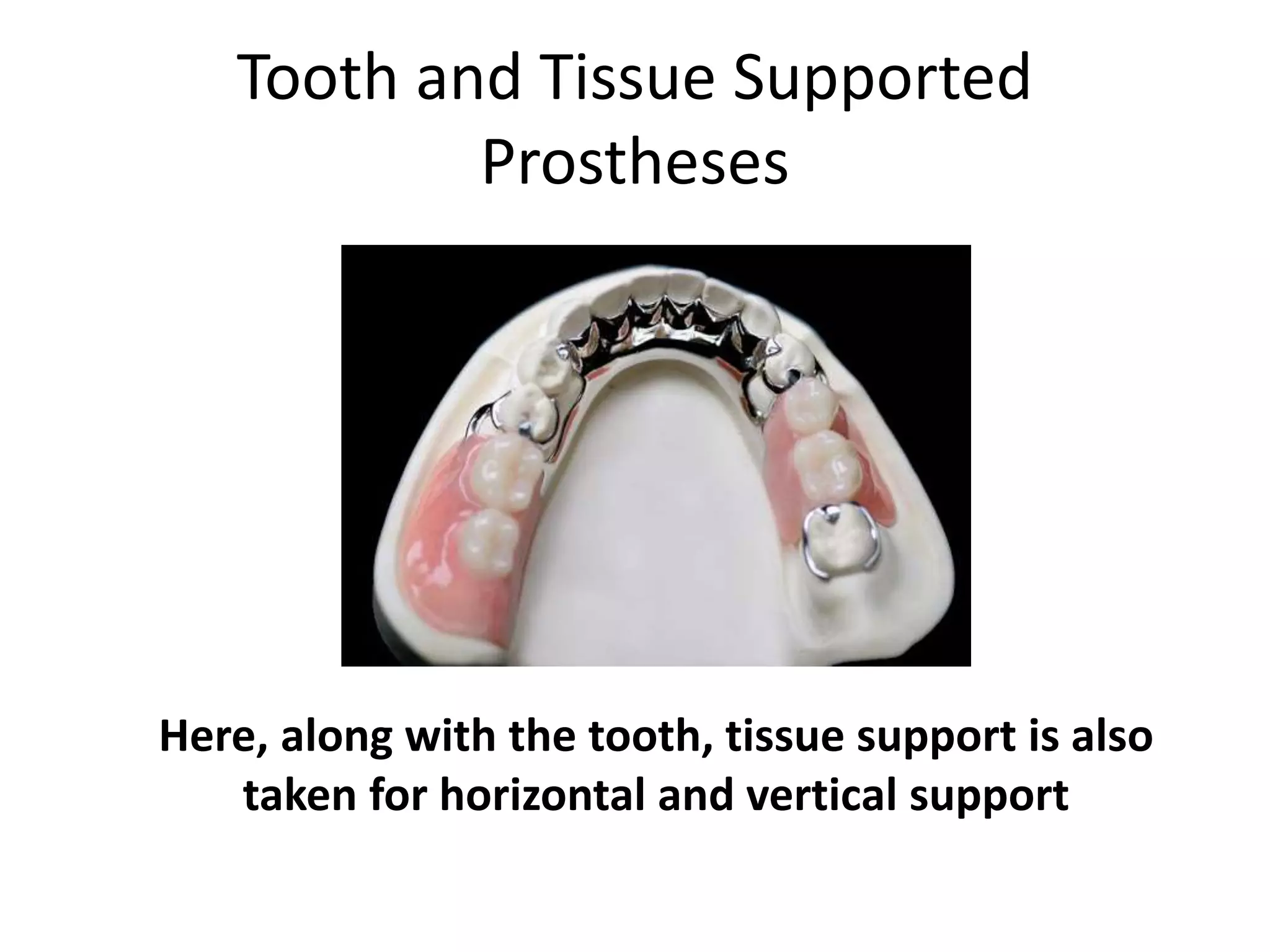 Mc Cracken chapter 2: Consideration for managing Partial tooth Loss | PPTX