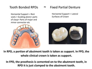 Mc Cracken chapter 2: Consideration for managing Partial tooth Loss | PPTX