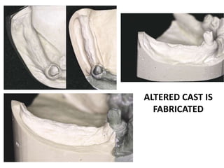 Mc Cracken chapter 2: Consideration for managing Partial tooth Loss | PPTX