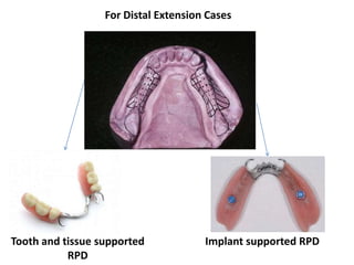 Mc Cracken chapter 2: Consideration for managing Partial tooth Loss | PPTX