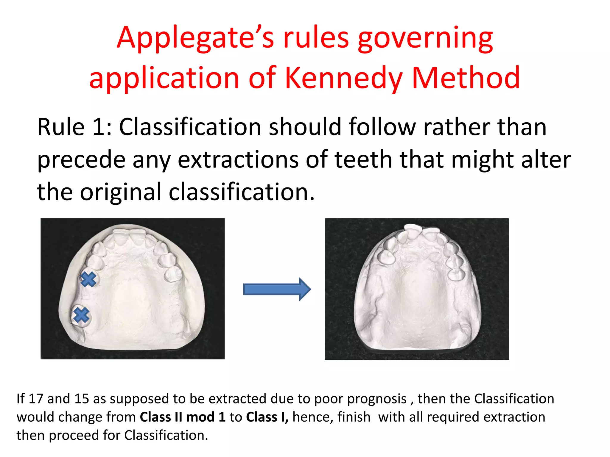 Mc Cracken chapter 3: Classification of Partially Edentulous Arches | PPTX