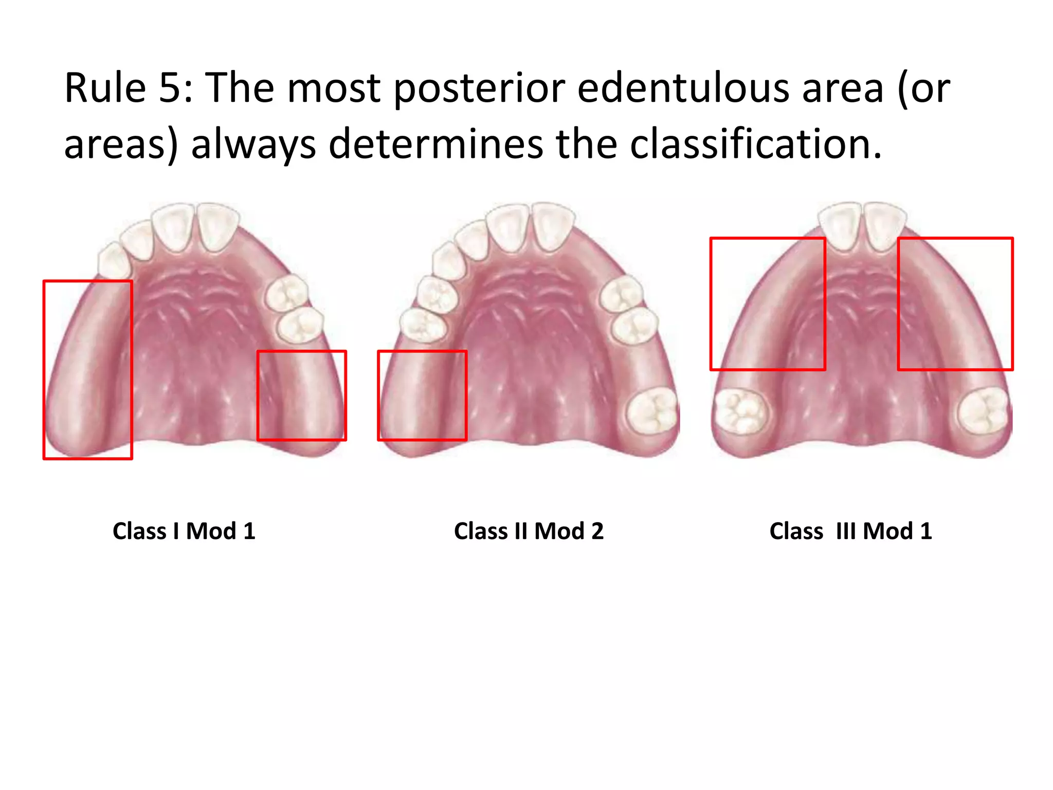 Mc Cracken chapter 3: Classification of Partially Edentulous Arches | PPTX