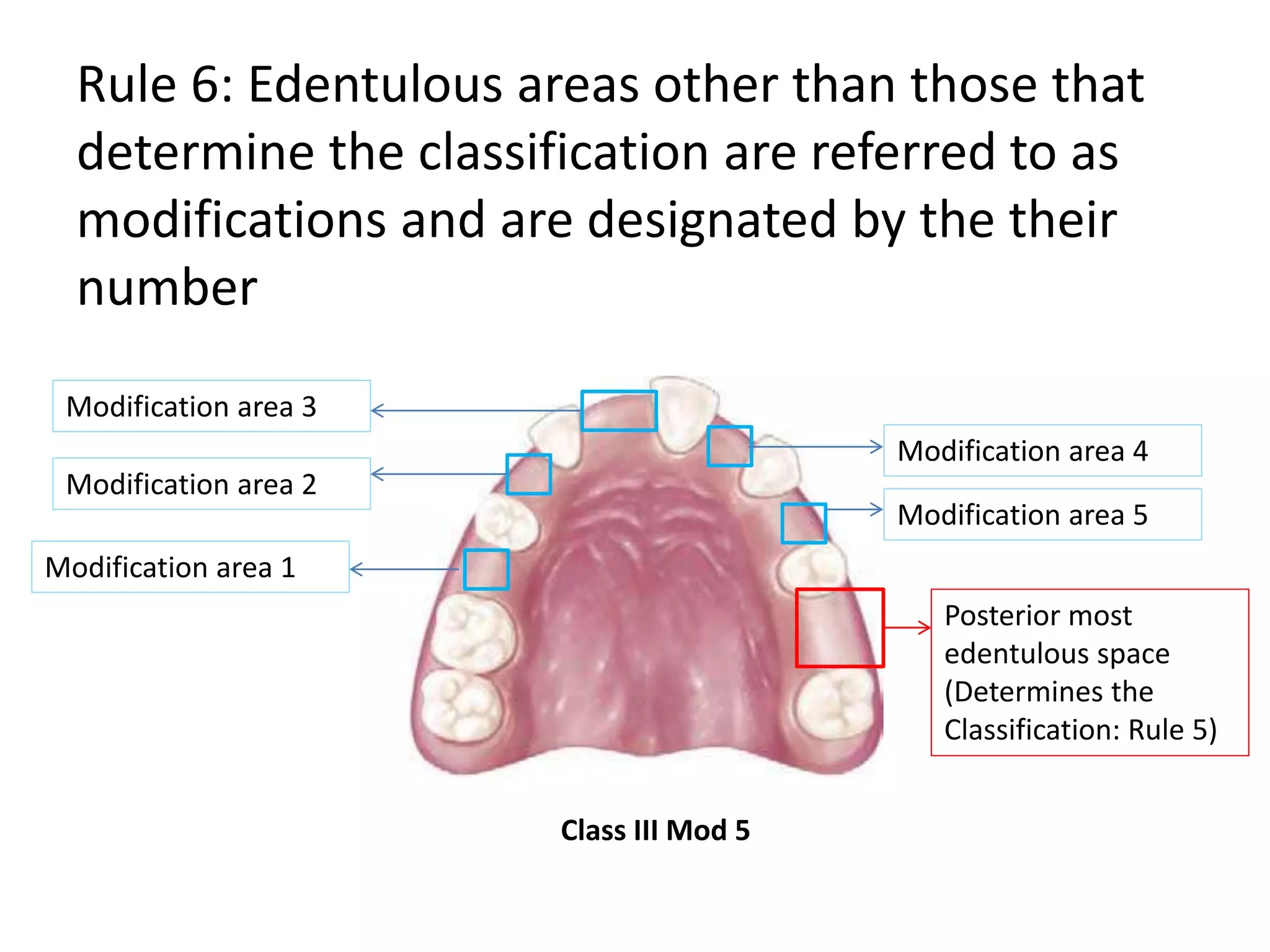 Mc Cracken chapter 3: Classification of Partially Edentulous Arches | PPTX