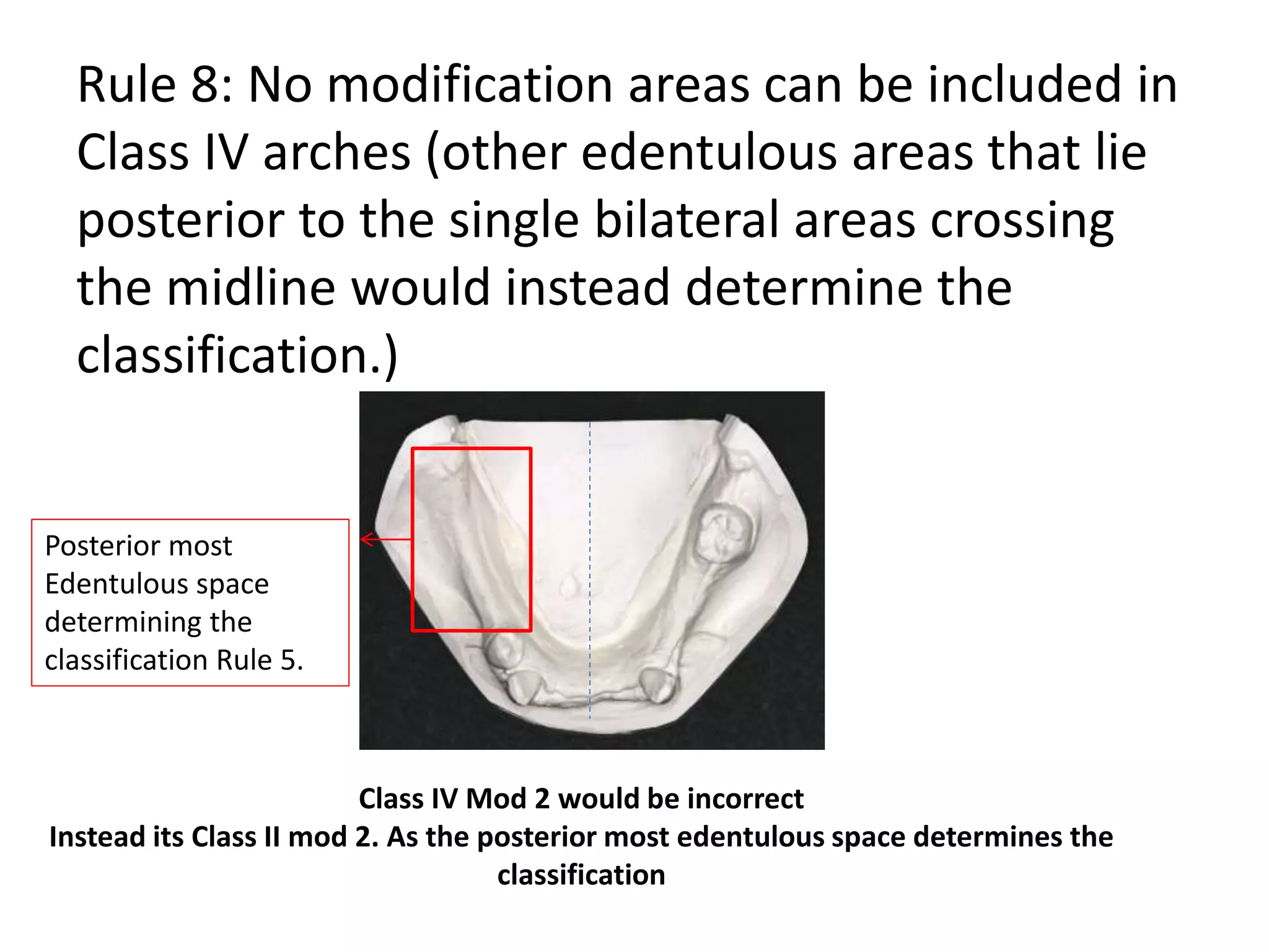 Mc Cracken chapter 3: Classification of Partially Edentulous Arches | PPTX