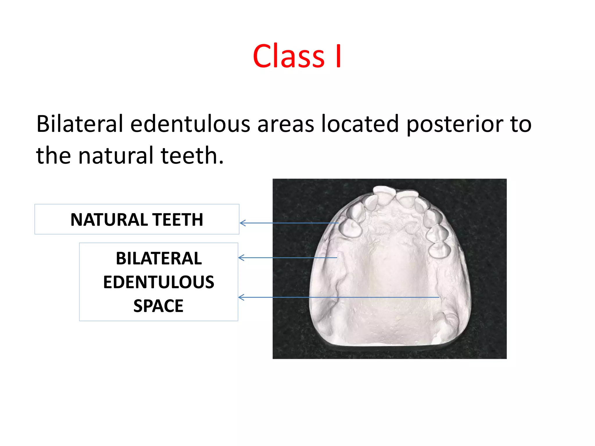 Mc Cracken chapter 3: Classification of Partially Edentulous Arches | PPTX