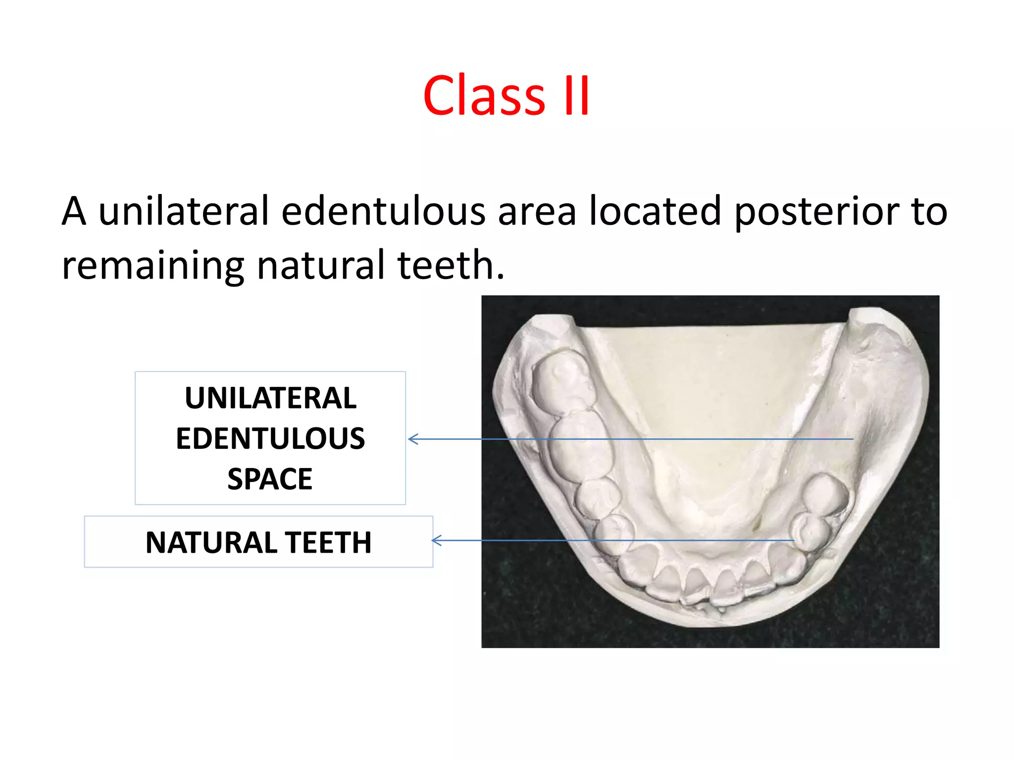 Mc Cracken chapter 3: Classification of Partially Edentulous Arches | PPTX