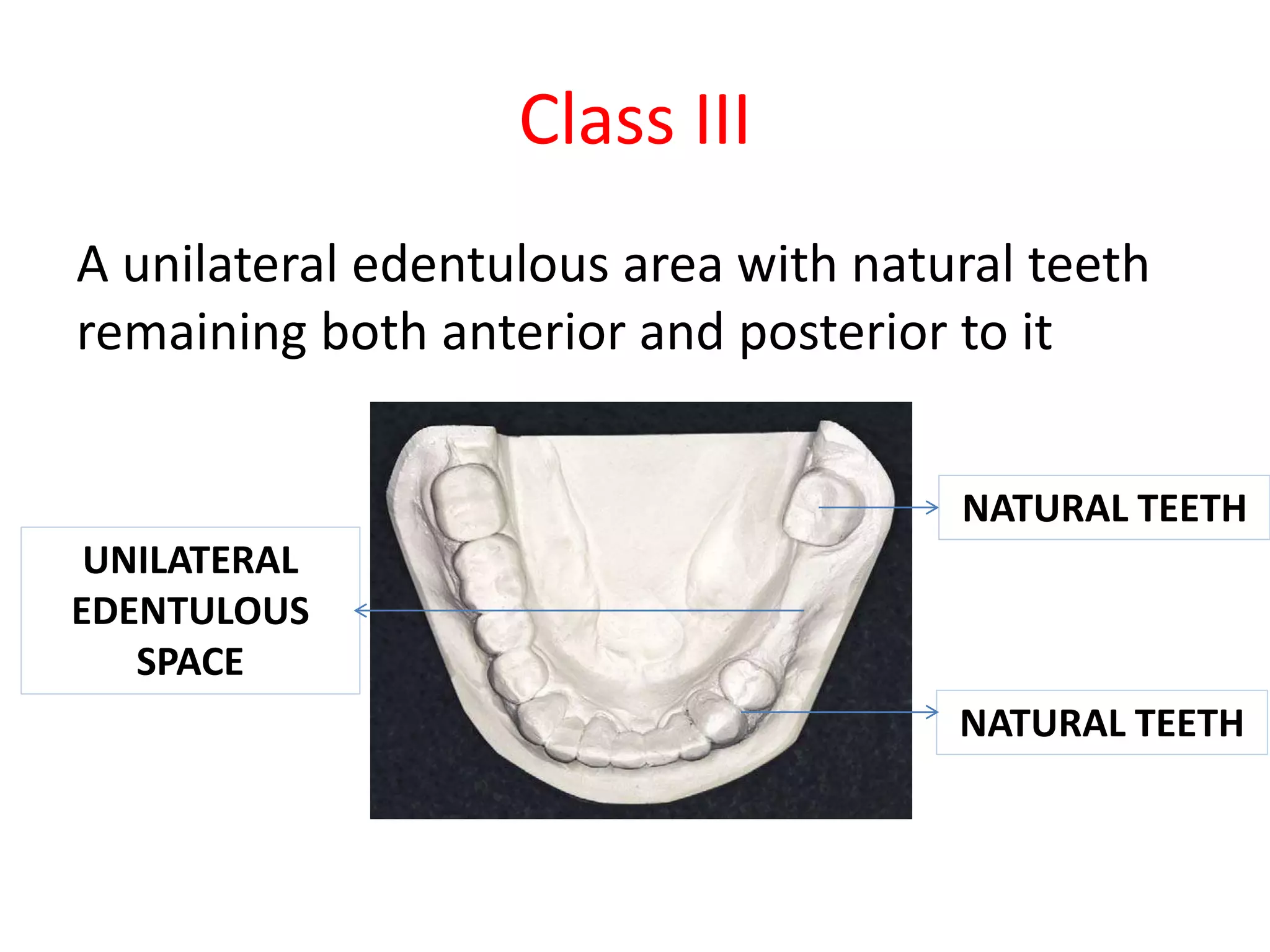 Mc Cracken chapter 3: Classification of Partially Edentulous Arches | PPTX