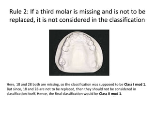 Mc Cracken chapter 3: Classification of Partially Edentulous Arches | PPTX