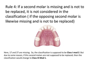 Mc Cracken chapter 3: Classification of Partially Edentulous Arches | PPTX