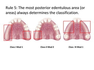 Mc Cracken chapter 3: Classification of Partially Edentulous Arches | PPTX