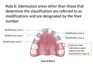 Mc Cracken chapter 3: Classification of Partially Edentulous Arches | PPTX