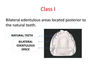 Mc Cracken chapter 3: Classification of Partially Edentulous Arches | PPTX
