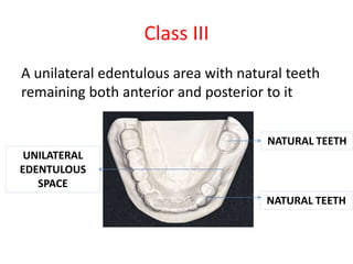 Mc Cracken chapter 3: Classification of Partially Edentulous Arches | PPTX