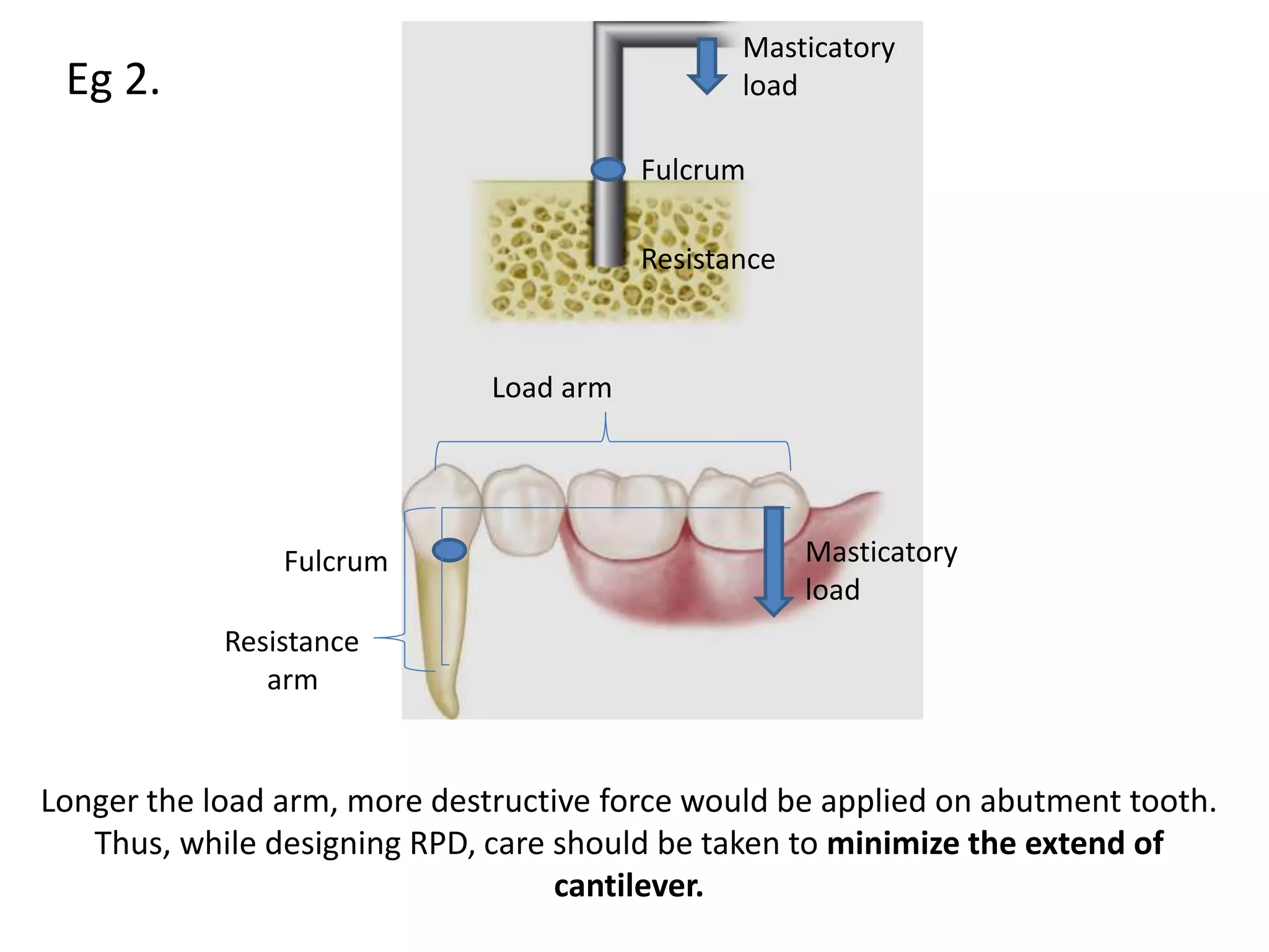 Mc Cracken chapter 4: Biomechanics of Removable Partial Denture. | PPTX