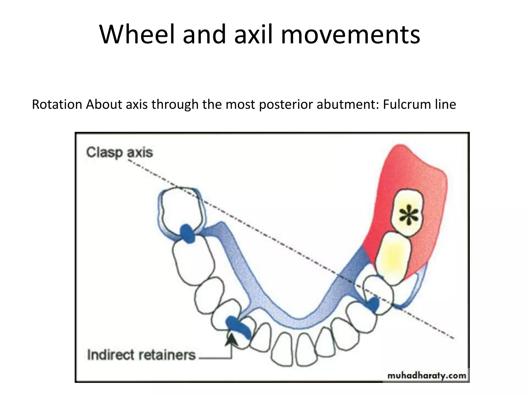 Mc Cracken chapter 4: Biomechanics of Removable Partial Denture. | PPTX