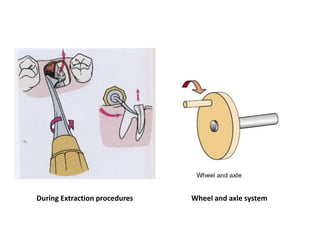 Mc Cracken chapter 4: Biomechanics of Removable Partial Denture. | PPTX