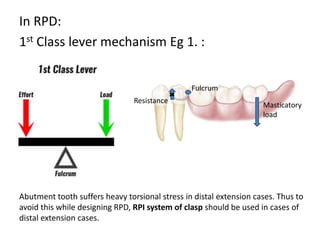 Mc Cracken chapter 4: Biomechanics of Removable Partial Denture. | PPTX