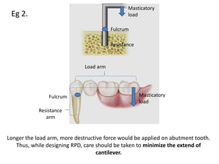 Mc Cracken chapter 4: Biomechanics of Removable Partial Denture. | PPTX