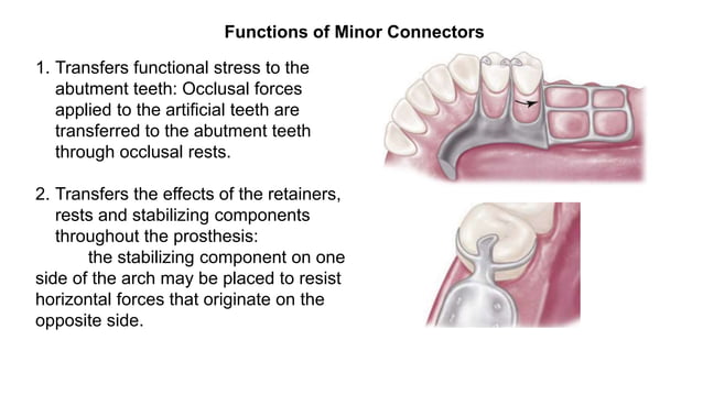 Major and Minor Connectors | PPTX | Oral care | Personal Care