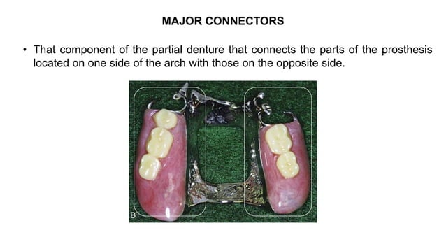 Major and Minor Connectors | PPTX | Oral care | Personal Care