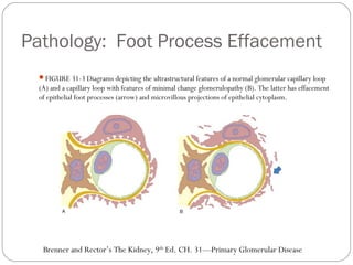Minimal Change Disease | PPT